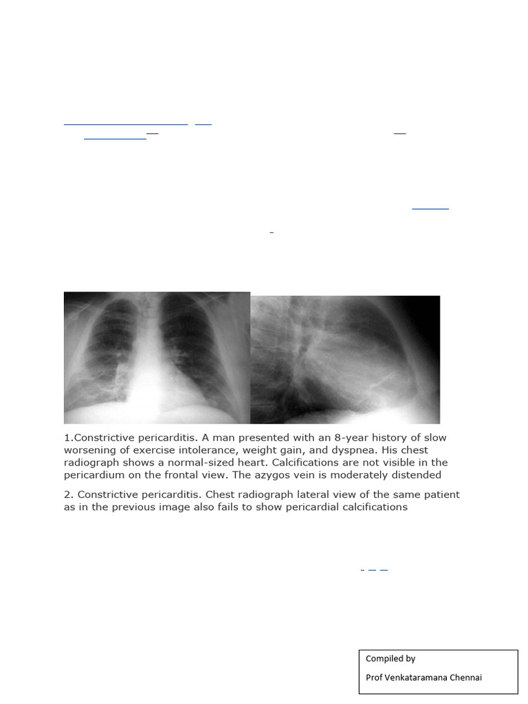 Constrictive Pericarditis | PDF | Heart | Echocardiography