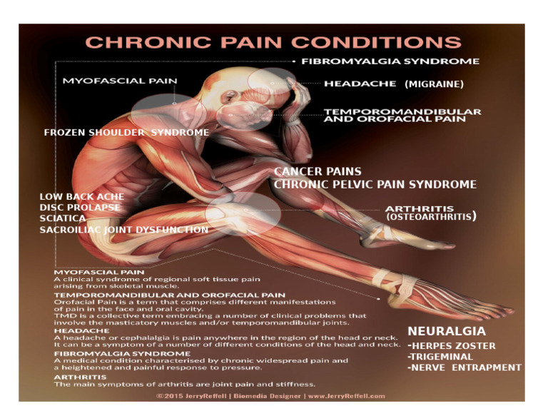 Chronic Pain Poster | PDF