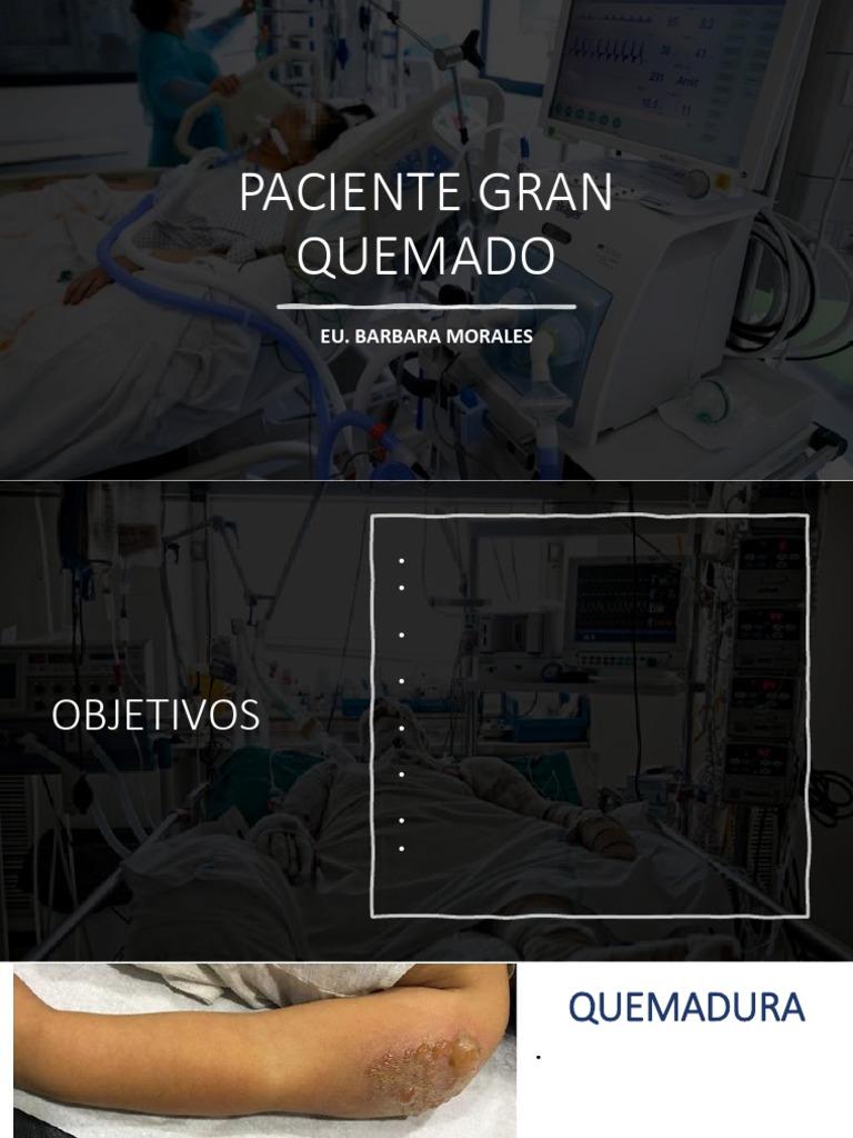 Gran Quemado | PDF | Quemar | Edema