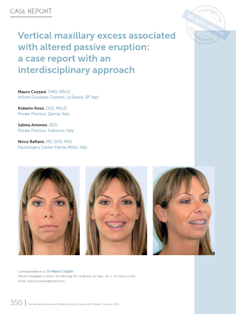 Vertical Maxillary Excess Associated With Altered Passive Eruption A ...