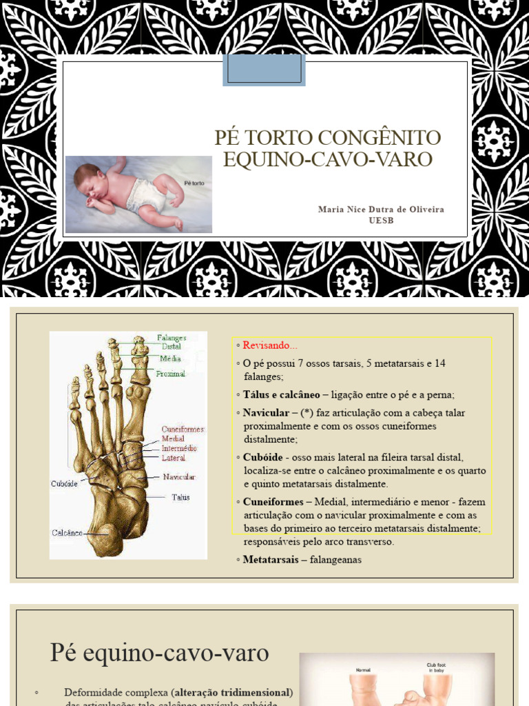 Pé Torto Congênito: Diagnóstico e Tratamento | PDF | Pé | Sistema Locomotor