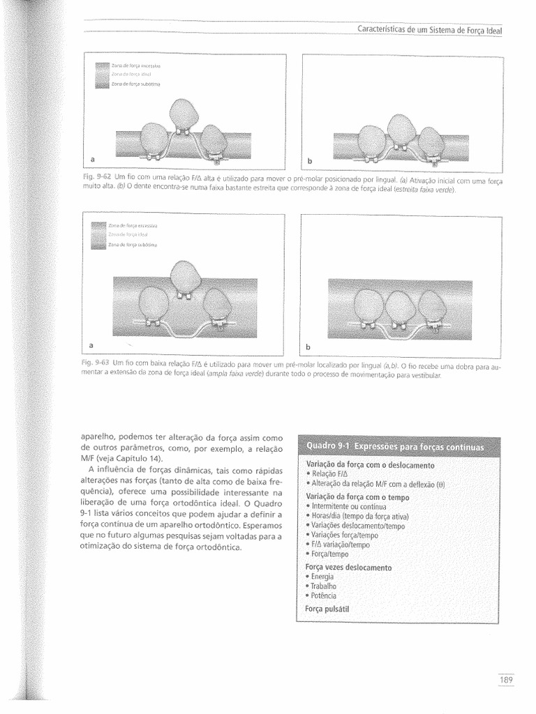 Burstone Parte 2 | PDF