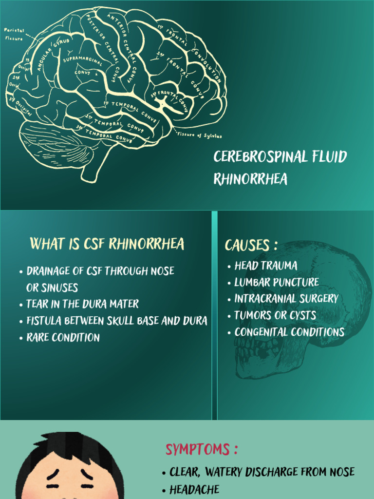CSF Rhinorrhea | PDF