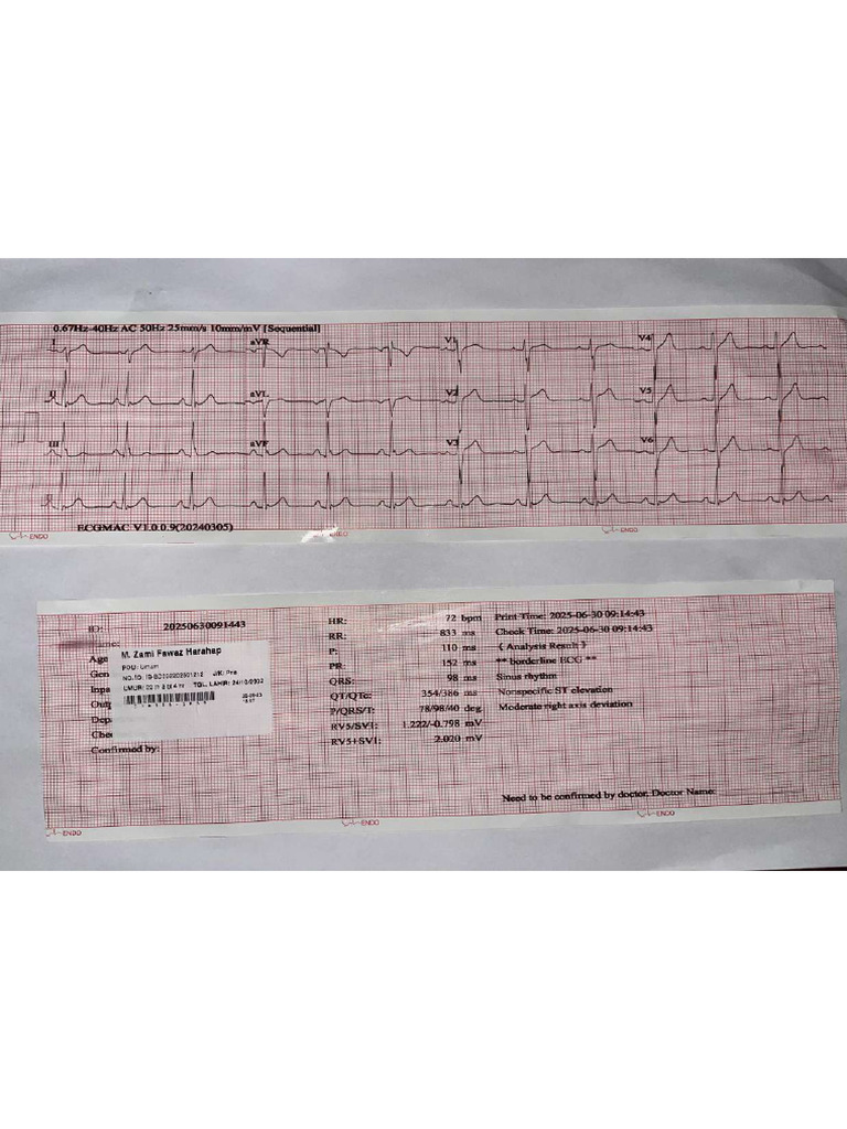 Ekg 30:06:2025 | PDF