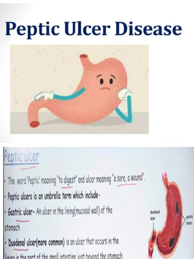 Peptic Ulcer Disease | PDF | Diseases And Disorders | Medical Specialties