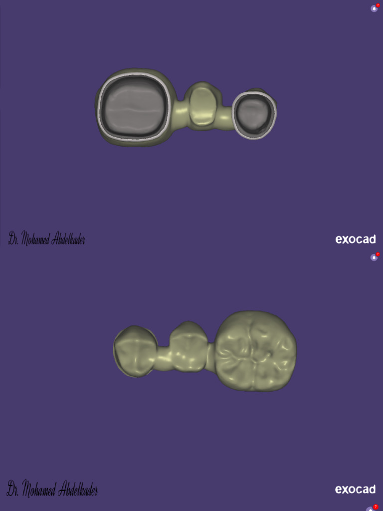 Posterior Bridge | PDF