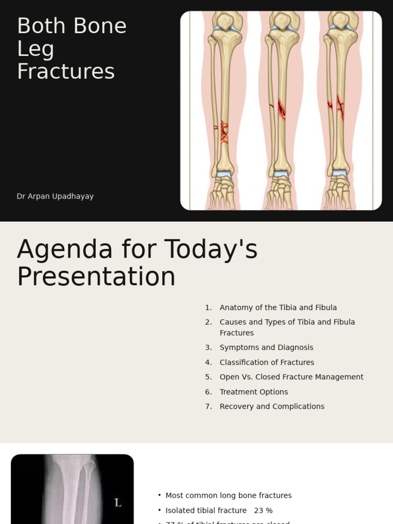 Understanding Both Bone Leg Fractures | PDF | Wound | Traumatology