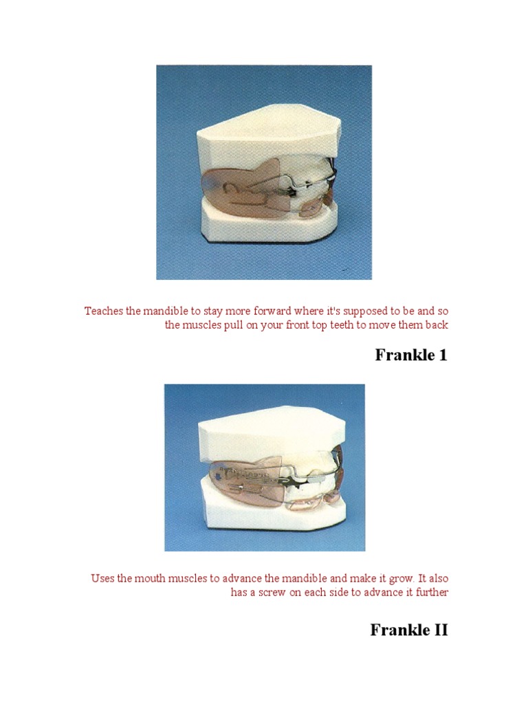 Frankle Appliances for Mandible Advancement | PDF