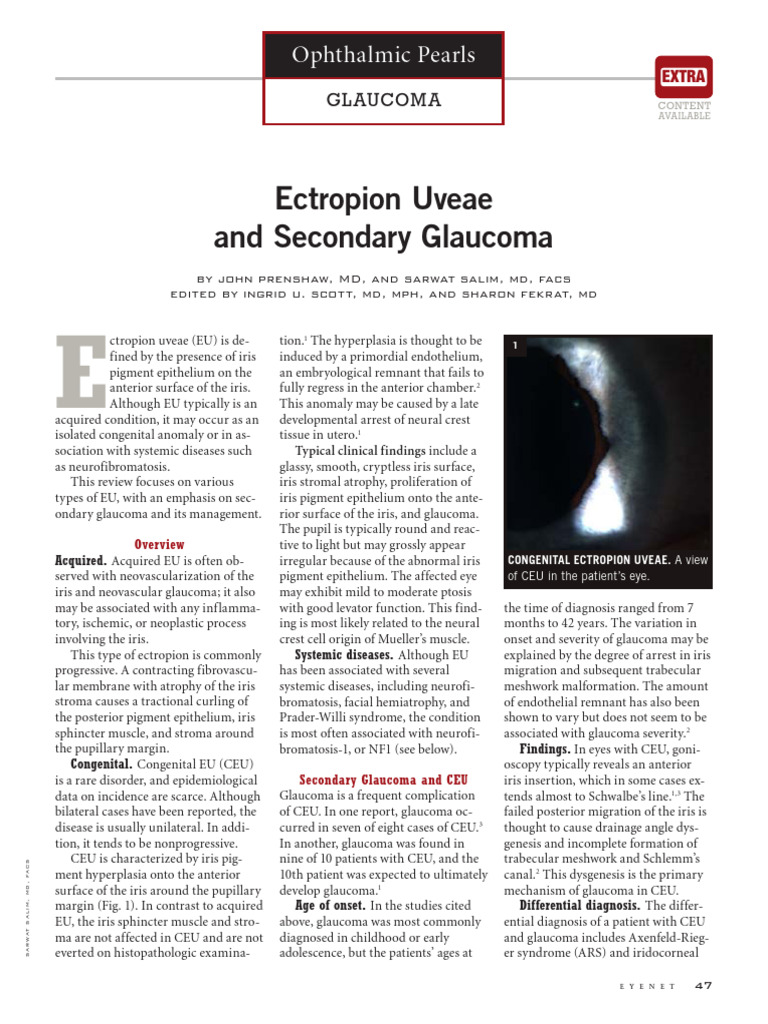 Ectropion Uveae and Glaucoma Insights | PDF | Glaucoma | Diseases And ...