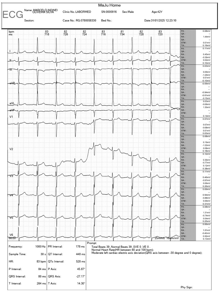 ECG Report for Marcelo Oliveira Silva | PDF | Cardiac Electrophysiology ...
