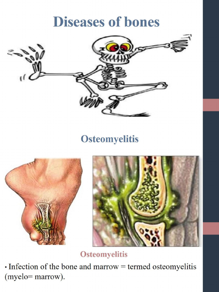 W10, Diseases of Bones | PDF