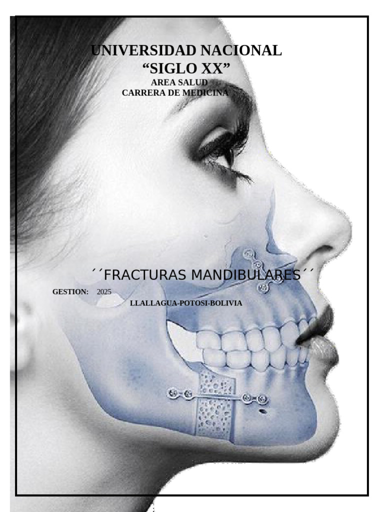 GRUPO NRO 2 Fracturas Mandibulares | PDF | Ct Scan | Cirugía