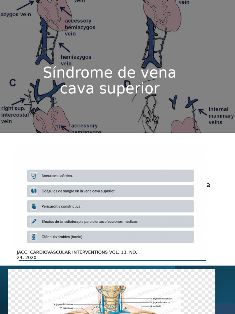Causas del Síndrome de Vena Cava Superior | PDF