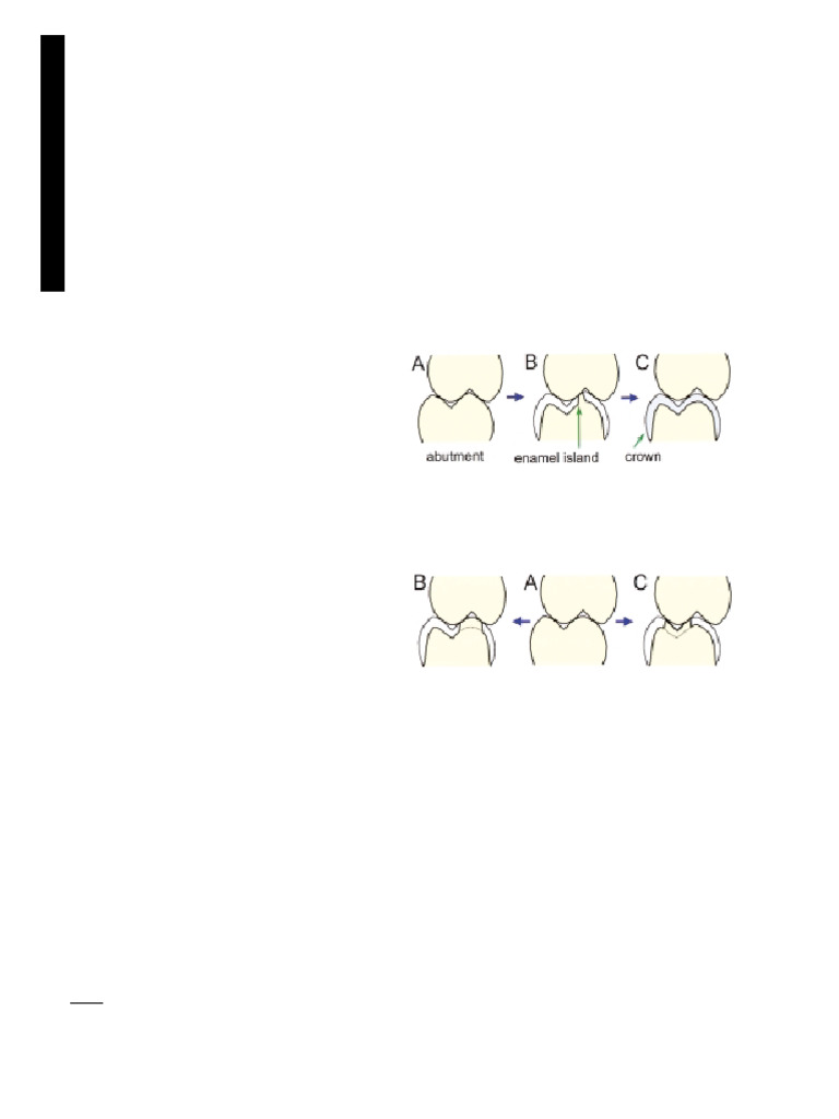 Accurate Interocclusal Records Method | PDF | Dental Implant | Dentistry