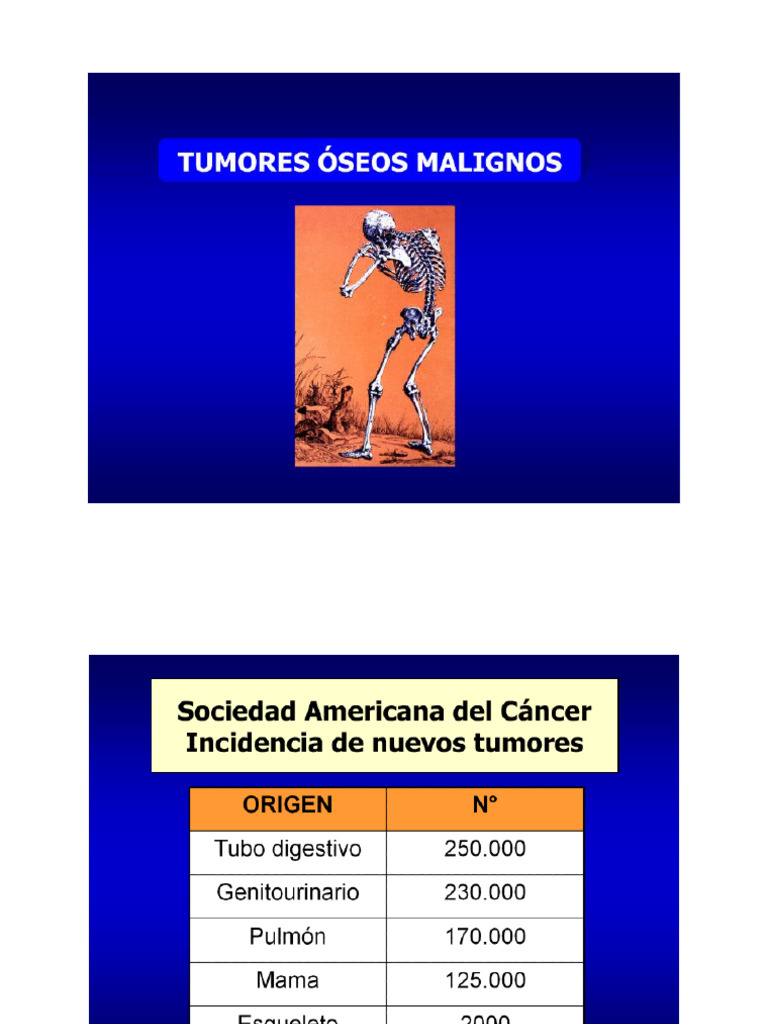 9.-Tumores Oseos Malignos | PDF