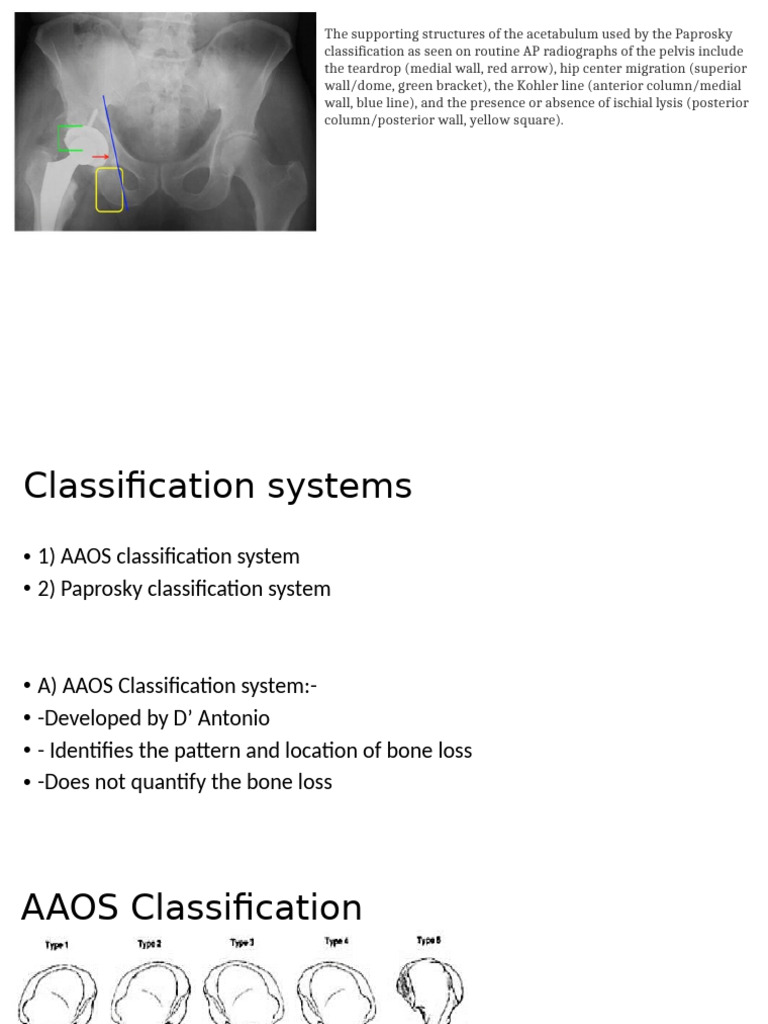 Acetabular Defects | PDF | Pelvis | Dental Implant