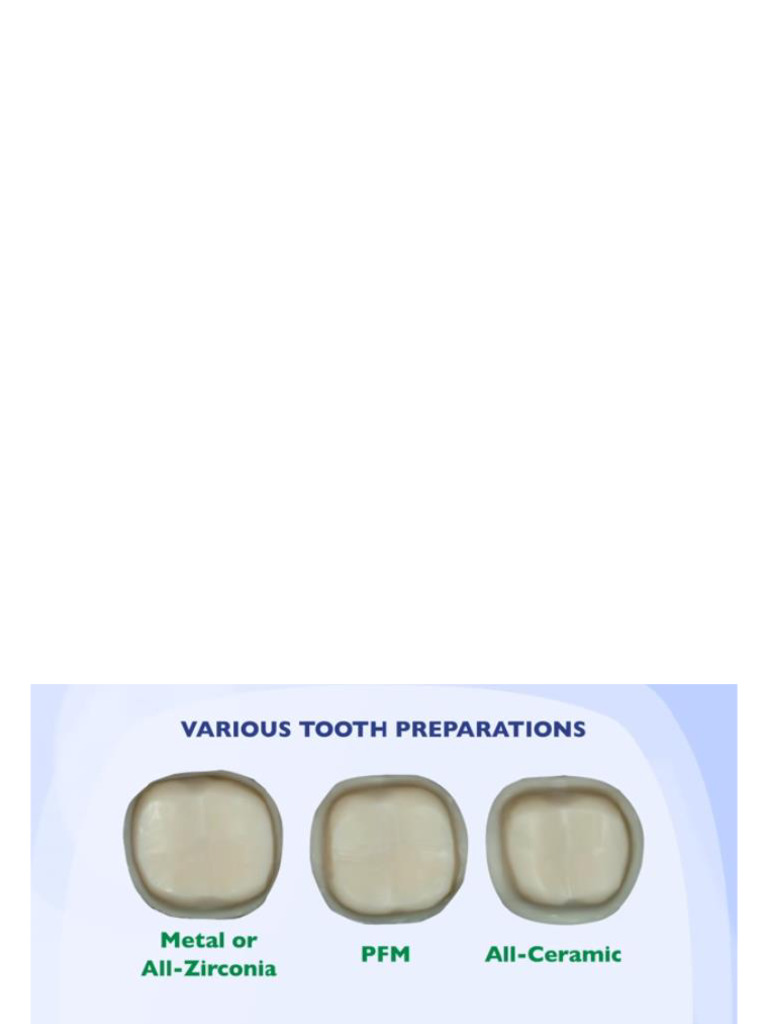 Metal Ceramic Crown Preparation Guide | PDF | Dentistry Branches | Mouth