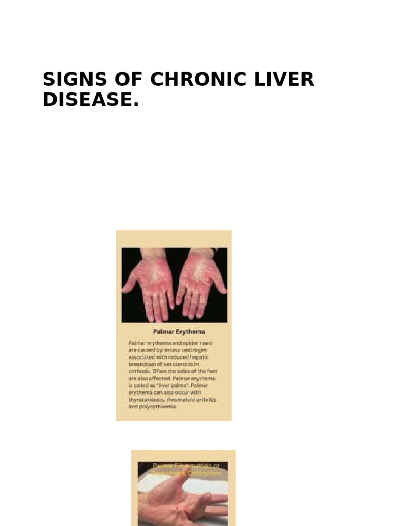 Signs of Chronic Liver Disease | PDF