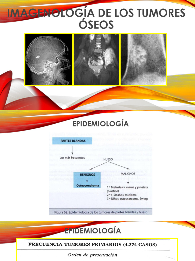 IMAGENOLOGIA DE LOS TUMORES OSEOS | PDF | Hueso | Neoplasias