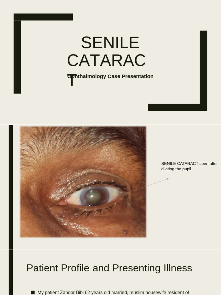 Senile Cataract Case Presentation | PDF | Cataract | Vision