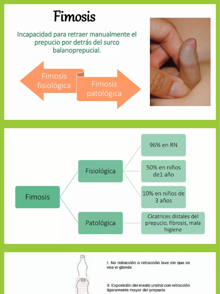 Ucsm Fimosis | PDF