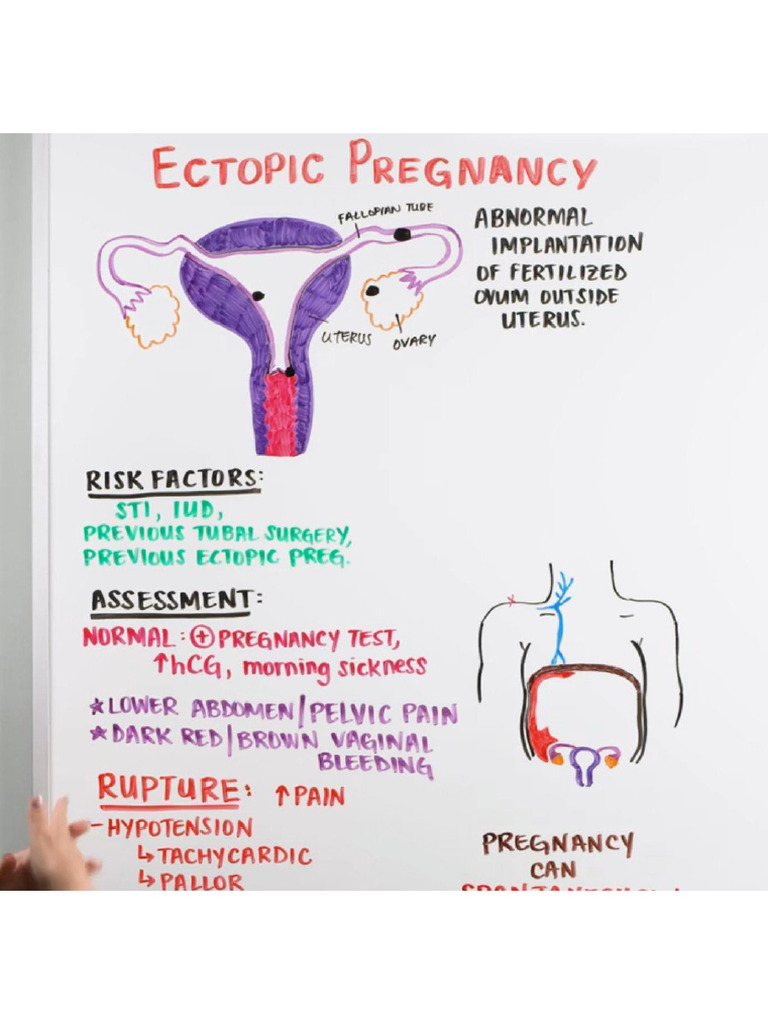 Ectopic Pregnancy | PDF
