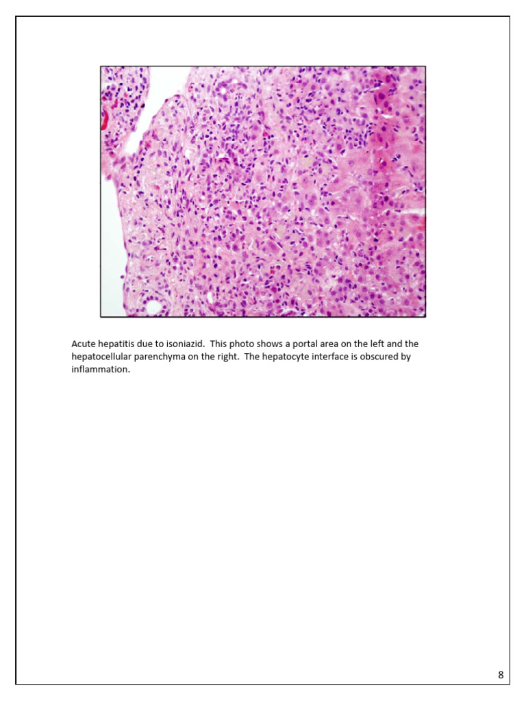 Livertox AcuteHepatitis 0008 | PDF