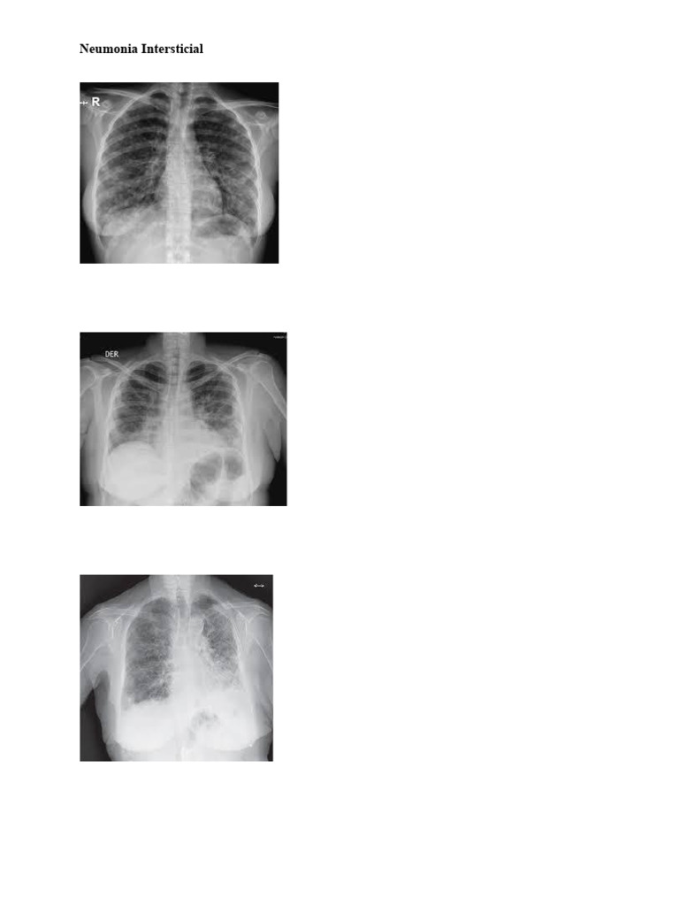 Imagenes Neumonia Pdf