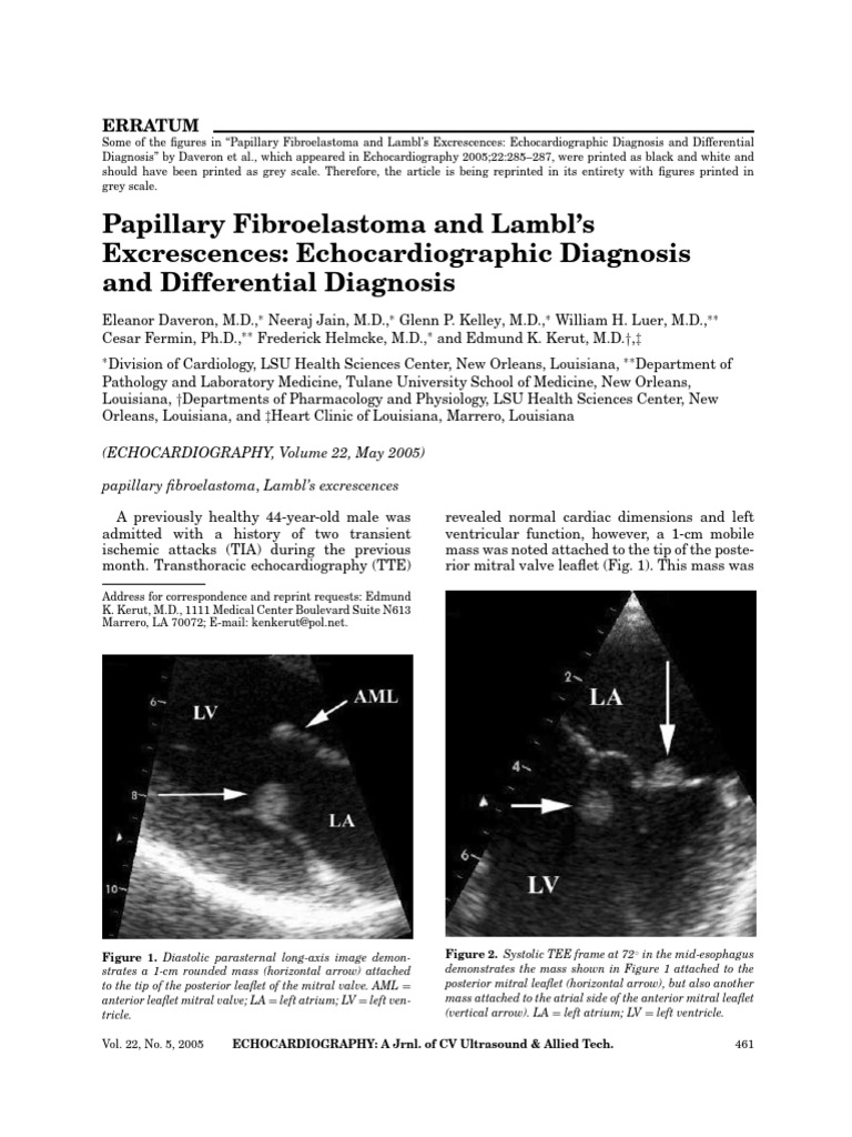 Echocardiography - 2005 - Daveron - Papillary Fibroelastoma and Lambl S ...
