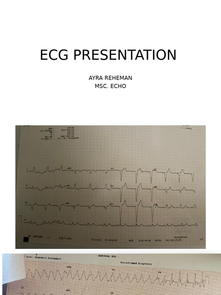 Ecg Presentation | PDF