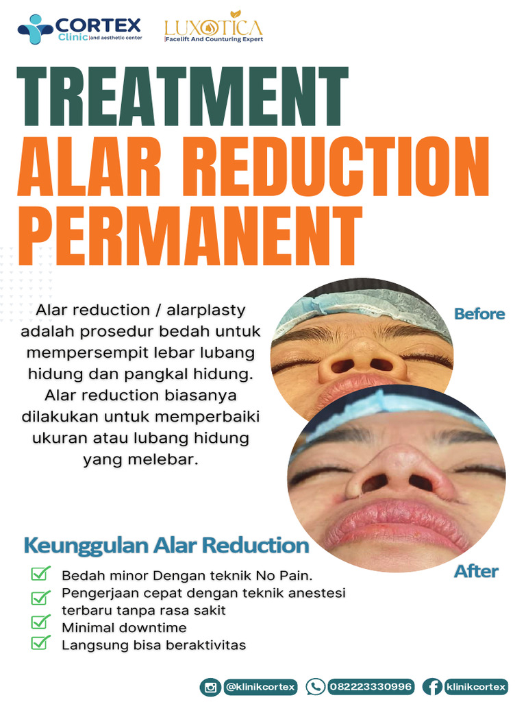 Alar Reduction | PDF