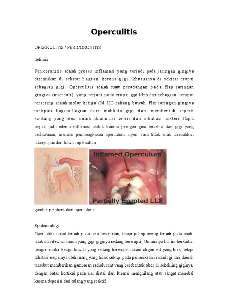 Operculitis | PDF