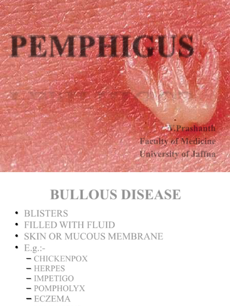 Pemphigus: Autoimmune Bullous Disease | PDF | Diseases And Disorders ...