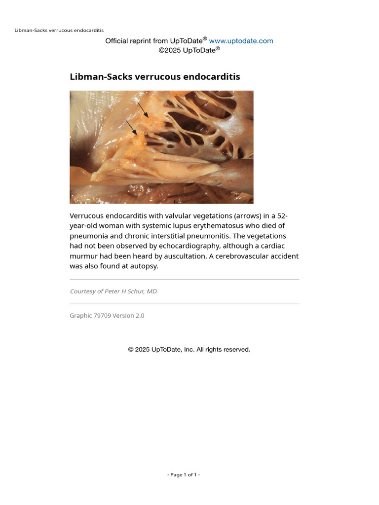 Libman-Sacks Verrucous Endocarditis Case | PDF