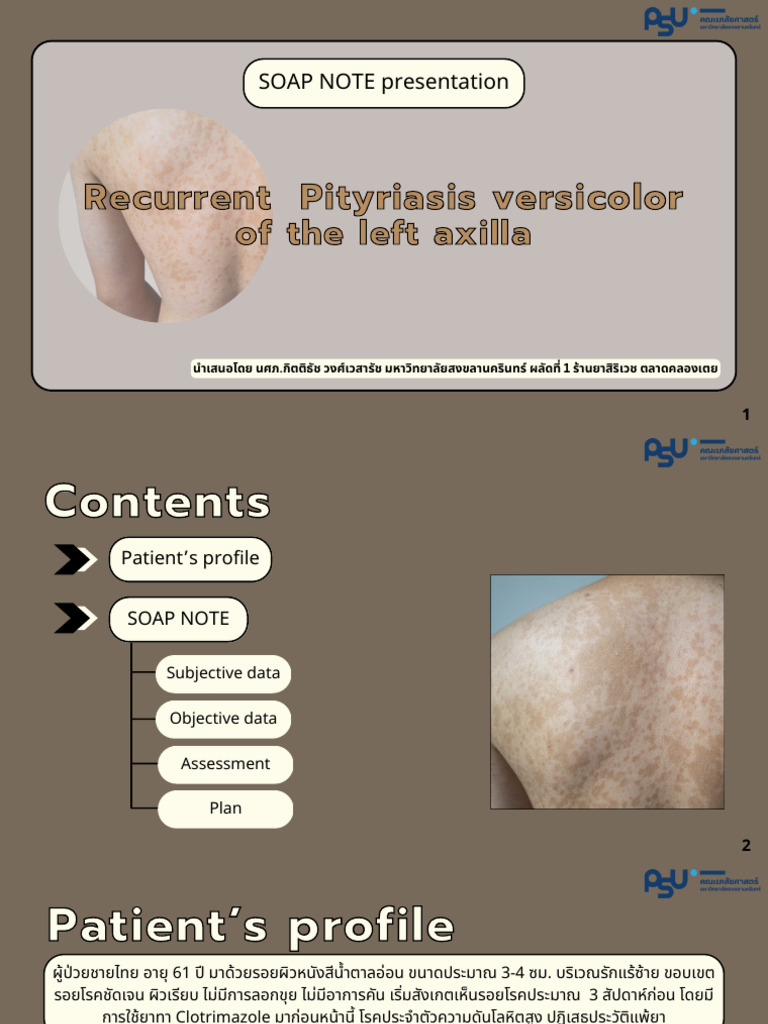 SOAP - Tinea Versicolor PDF | PDF