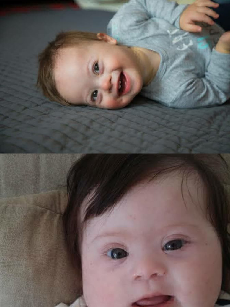 Down Syndrome | PDF