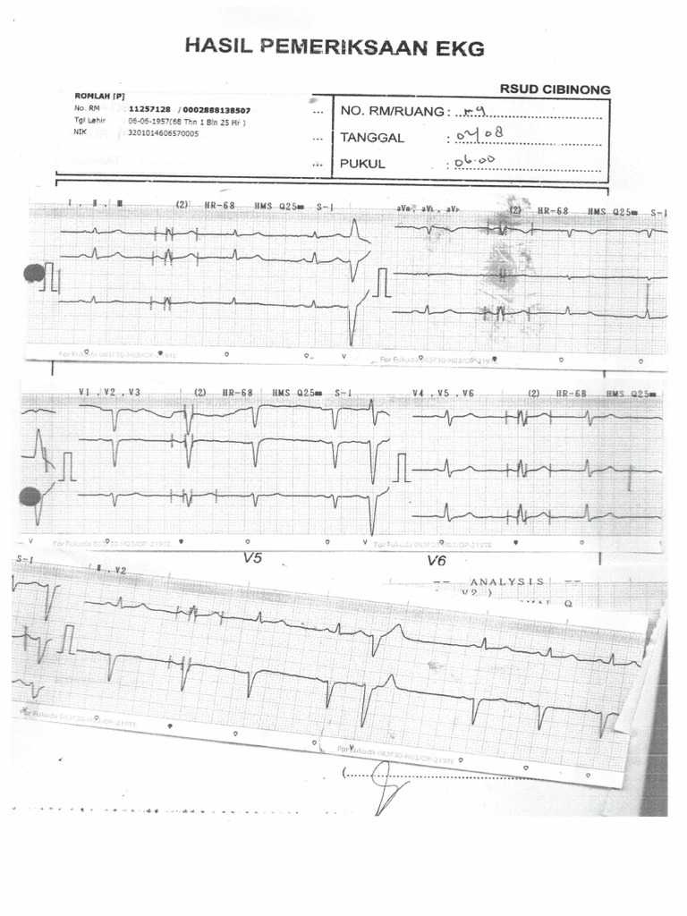 Ekg Atrial Extrasystole | PDF