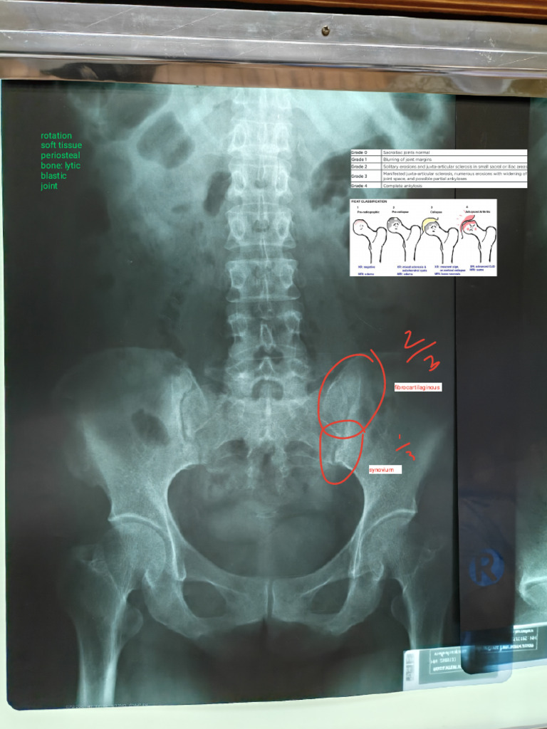 Rotation Soft Tissue Periosteal Bone: Lytic Blastic Joint ...