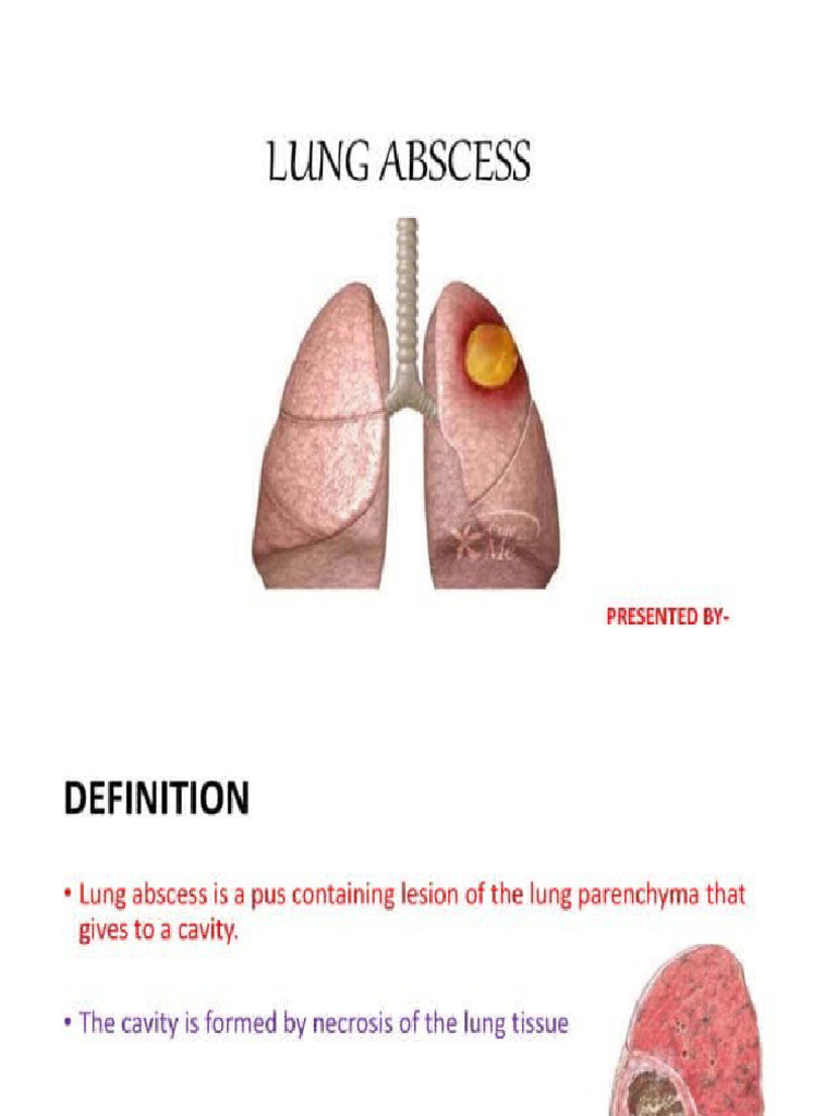 Lung Abscess | PDF
