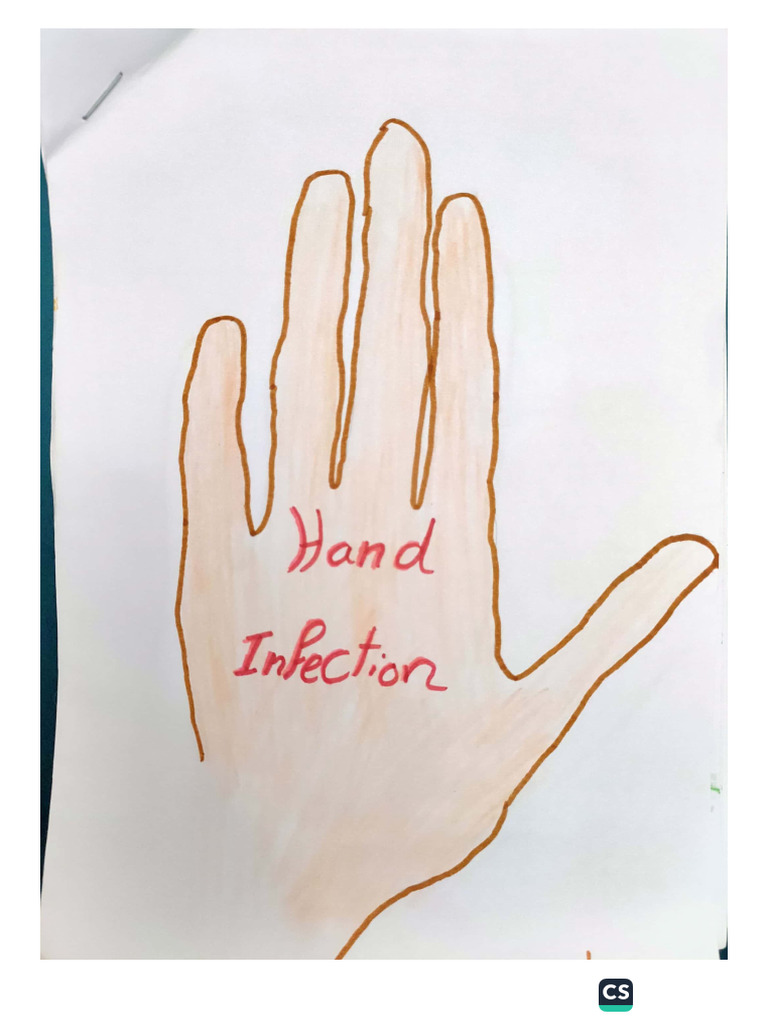 Hand Infection | PDF