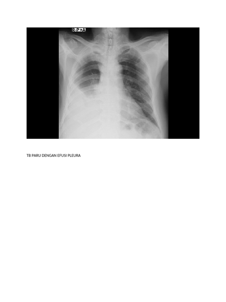 TB Paru Dengan Efusi Pleura | PDF