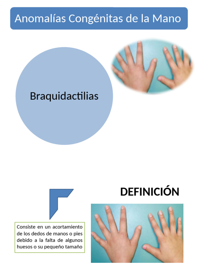 Braquidactilias y Simbraquidactilia | PDF | Mano | Hueso