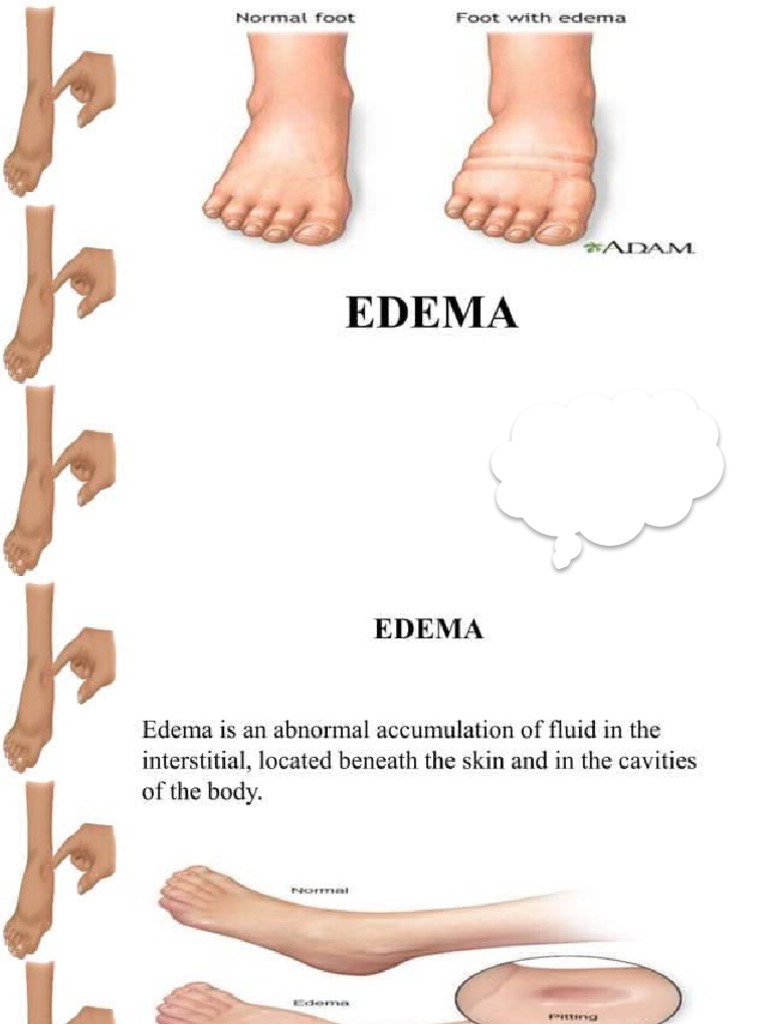 Edema | PDF