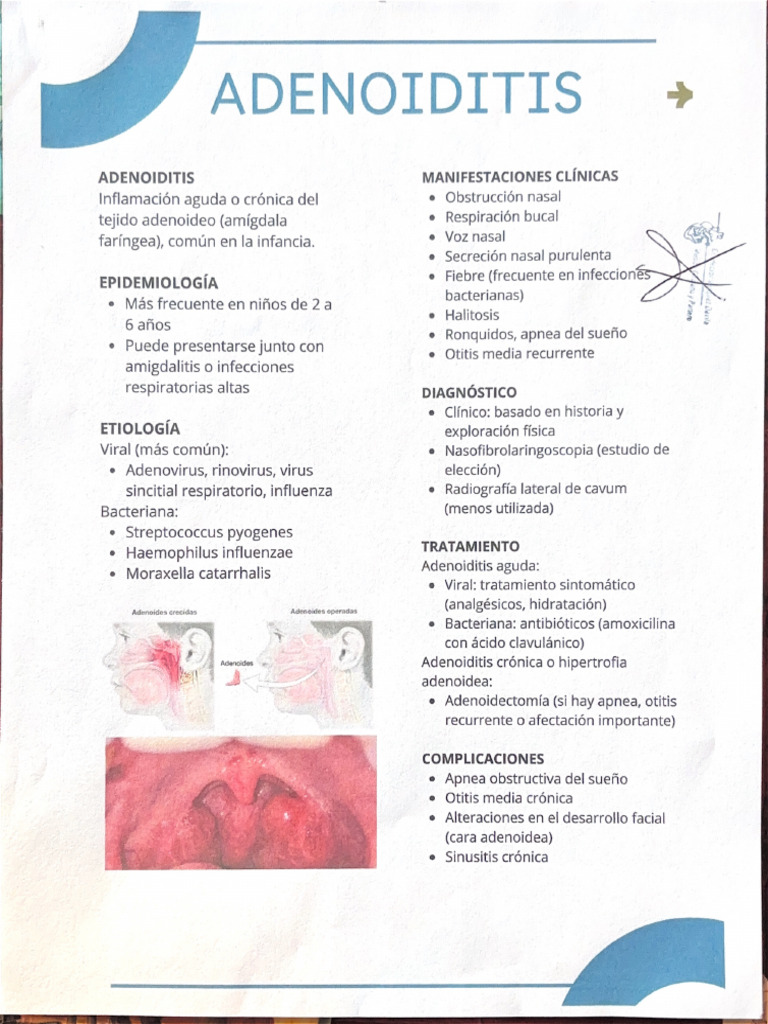 ADENOIDITIS | PDF