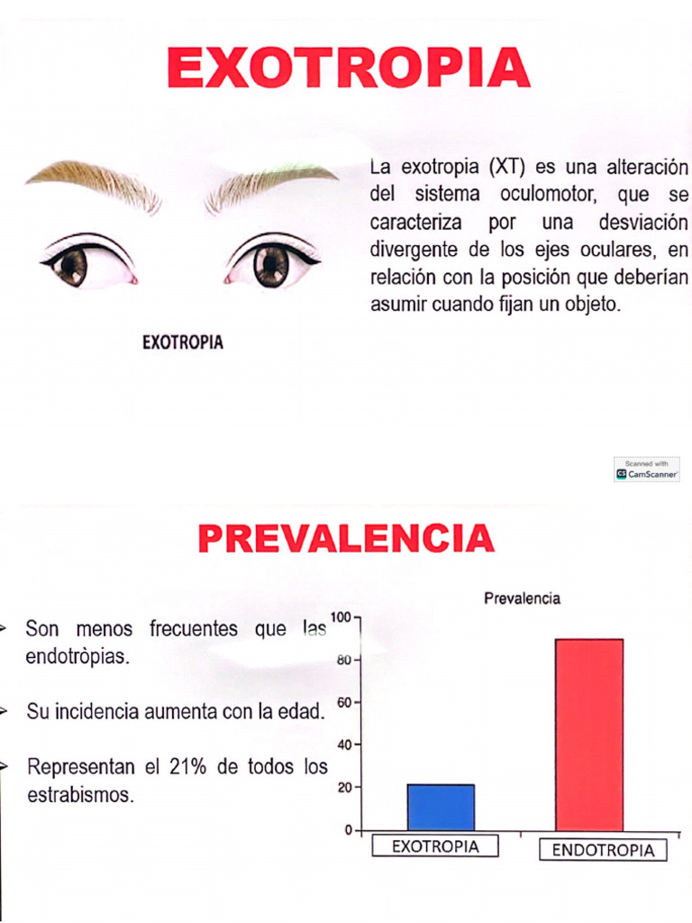Exotropia | PDF