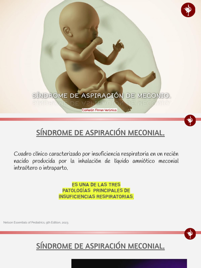 Síndrome de Aspiración Meconial | PDF | Respiración | Enfermedades y ...