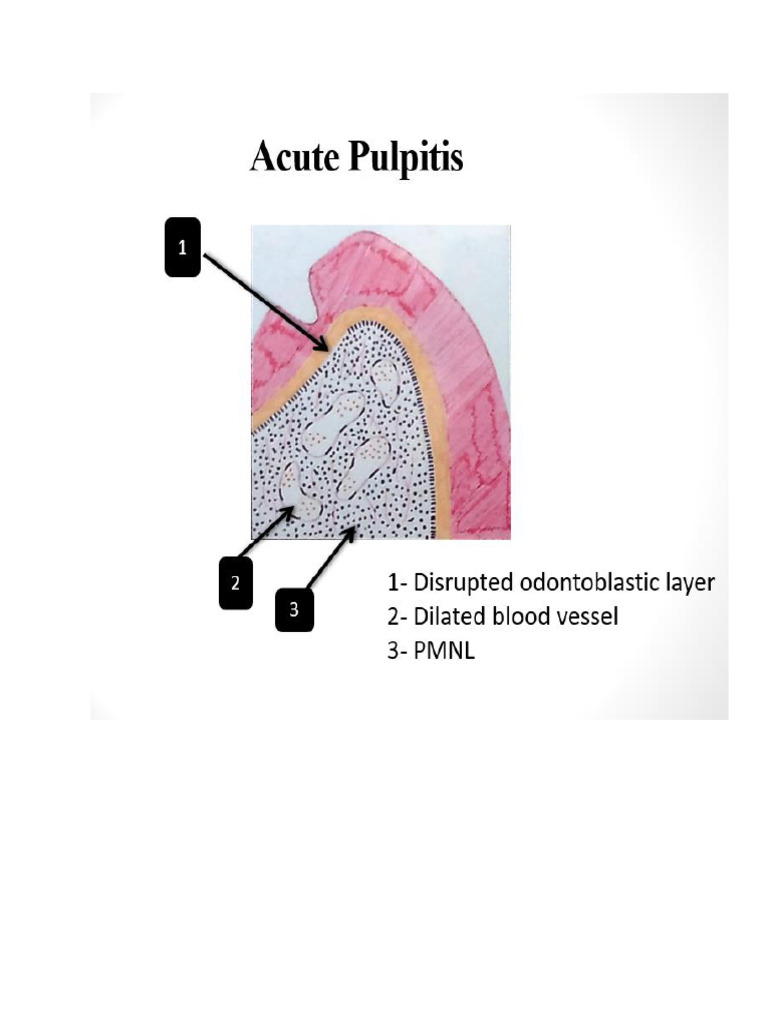 Acute Pulpitis | PDF