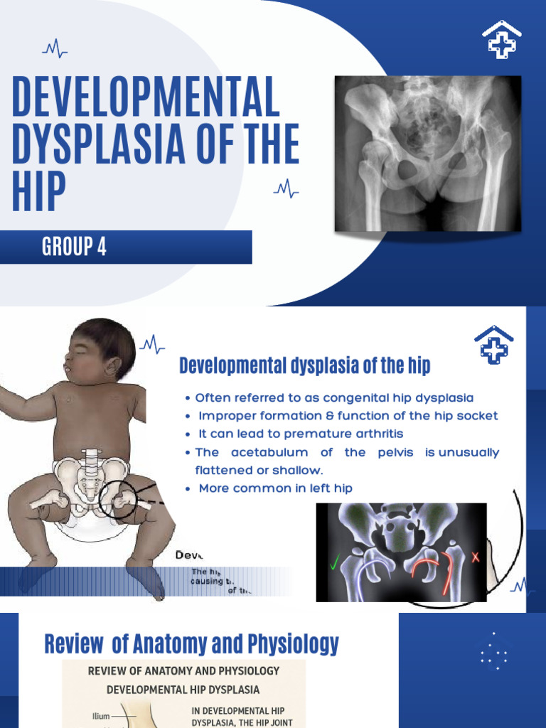 Pediatric Management of Hip Dysplasia | PDF