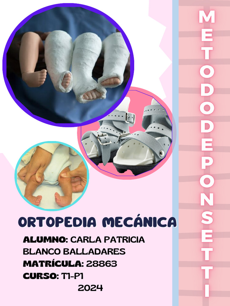 Metodo de Ponsetti | PDF | Especialidades Medicas
