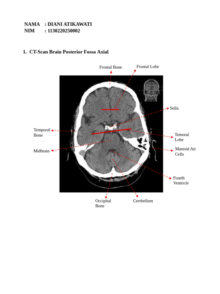 Anantomi CT-Scan Brain Image Posterior Fossa | PDF